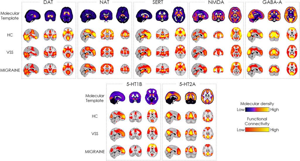 Learn About Visual Snow Syndrome | Visual Snow Initiative
